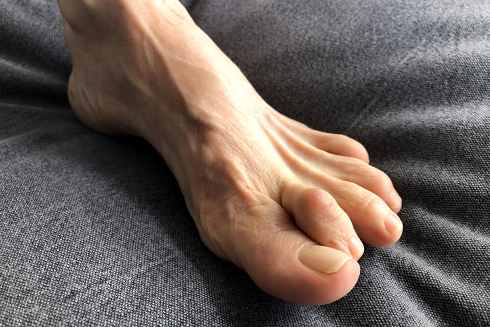 Hammer Toes Correction - Bespoke Podiatry - Union Square, New York City